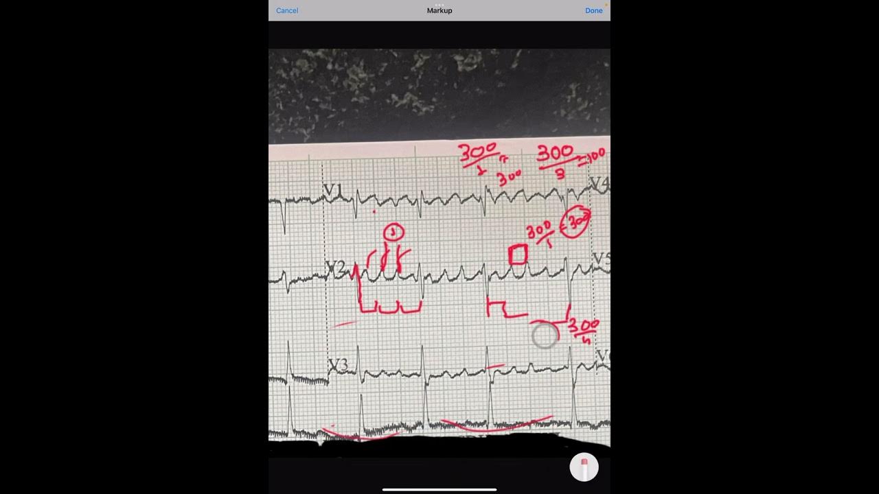 ECG - ATRIAL FLUTTER - YouTube