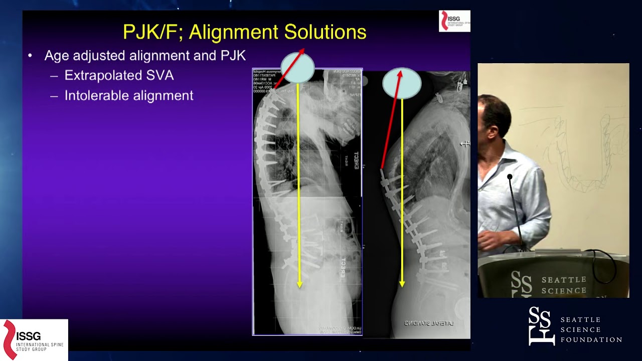 Effective Prevention of Proximal Junctional Failure PJF in Adult Spinal ...
