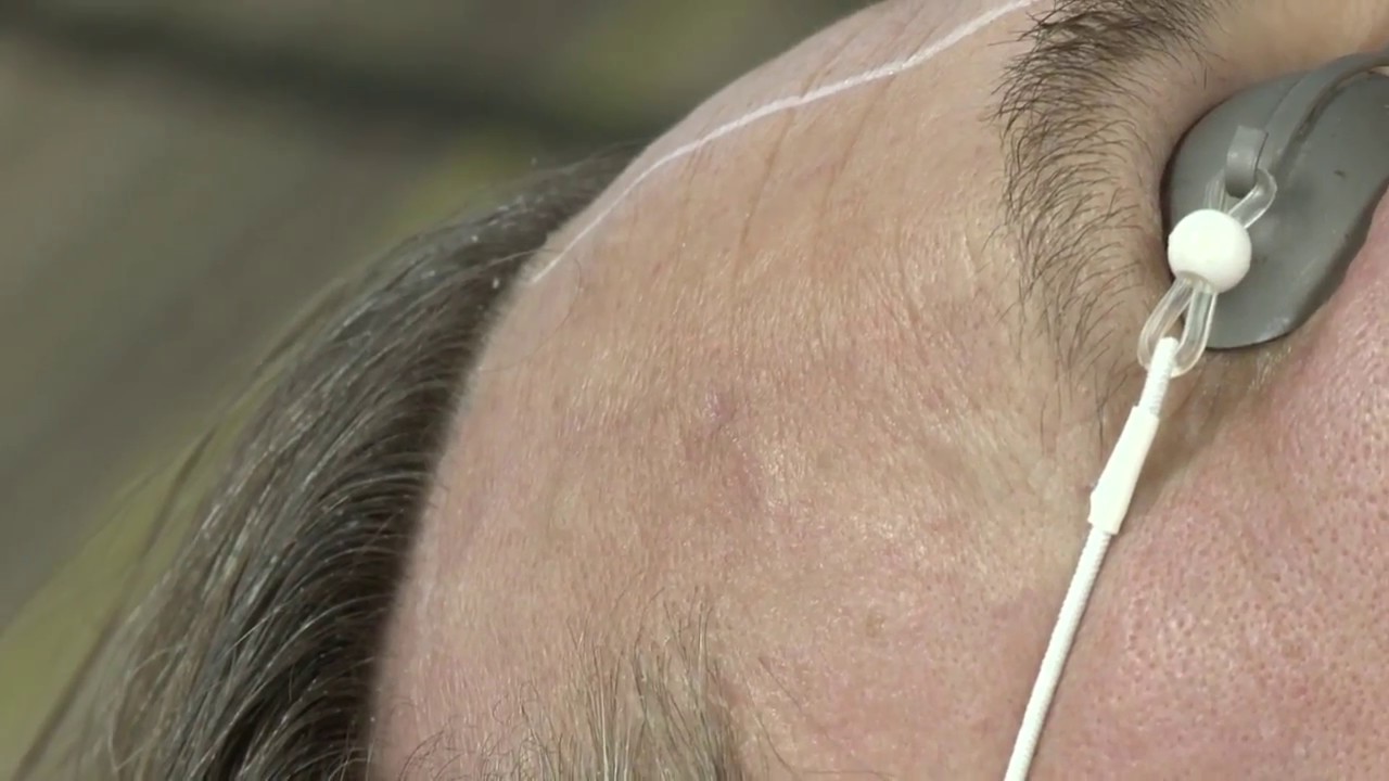 Fractional Skin Resurfacing with Ellipse Frax 1550: Part 6 - YouTube