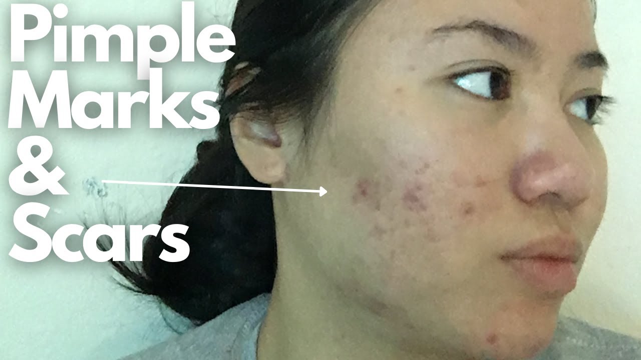 Pimple Marks and Holes on Face | Causes, prevention, and treatment of ...