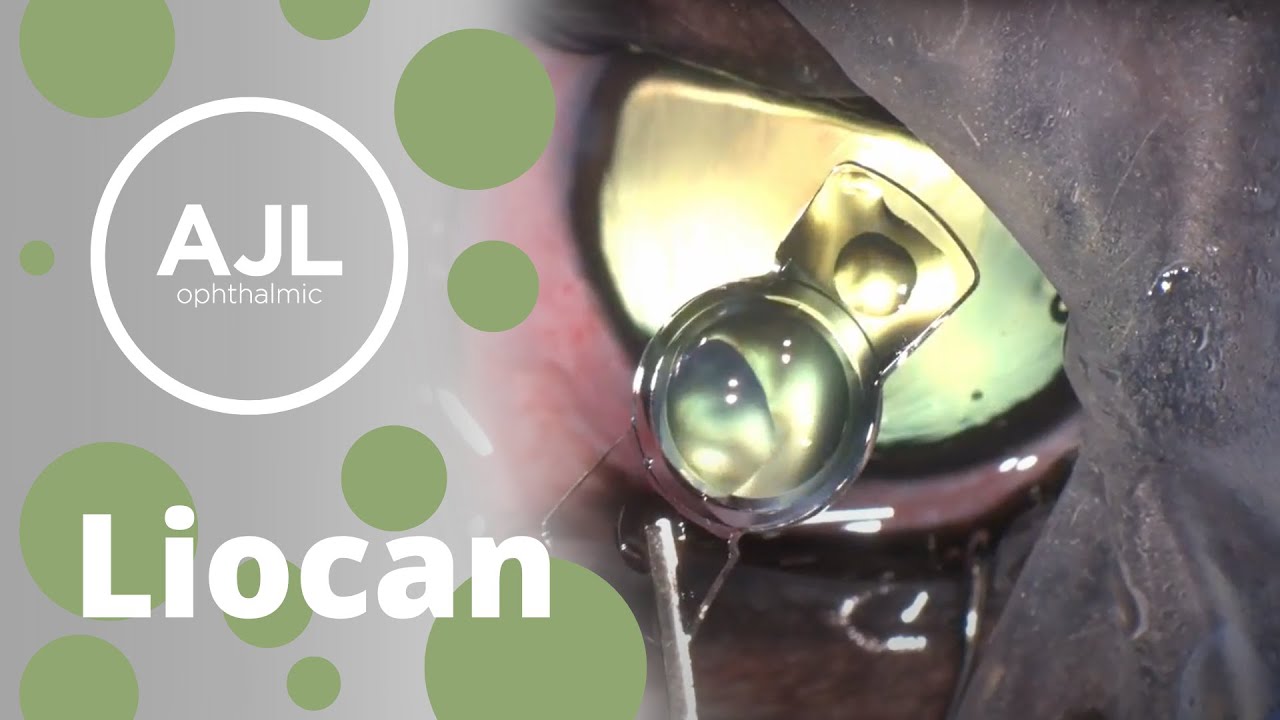 Liocan IOL loading & injection - YouTube