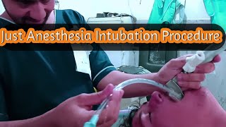 General Anesthesia Intubation Procedure |Just General A... | Doovi