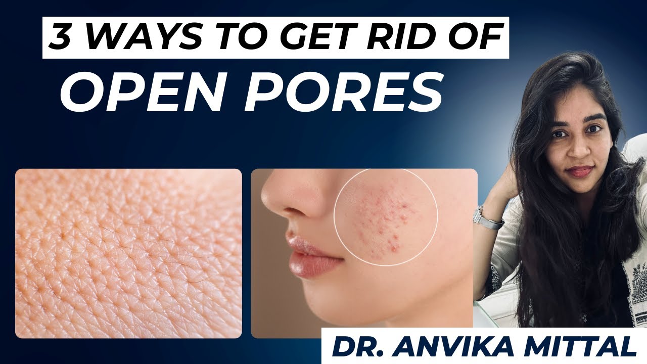 Expert Tips to Reduce Open Pores | Explained By Dermatologist Dr ...