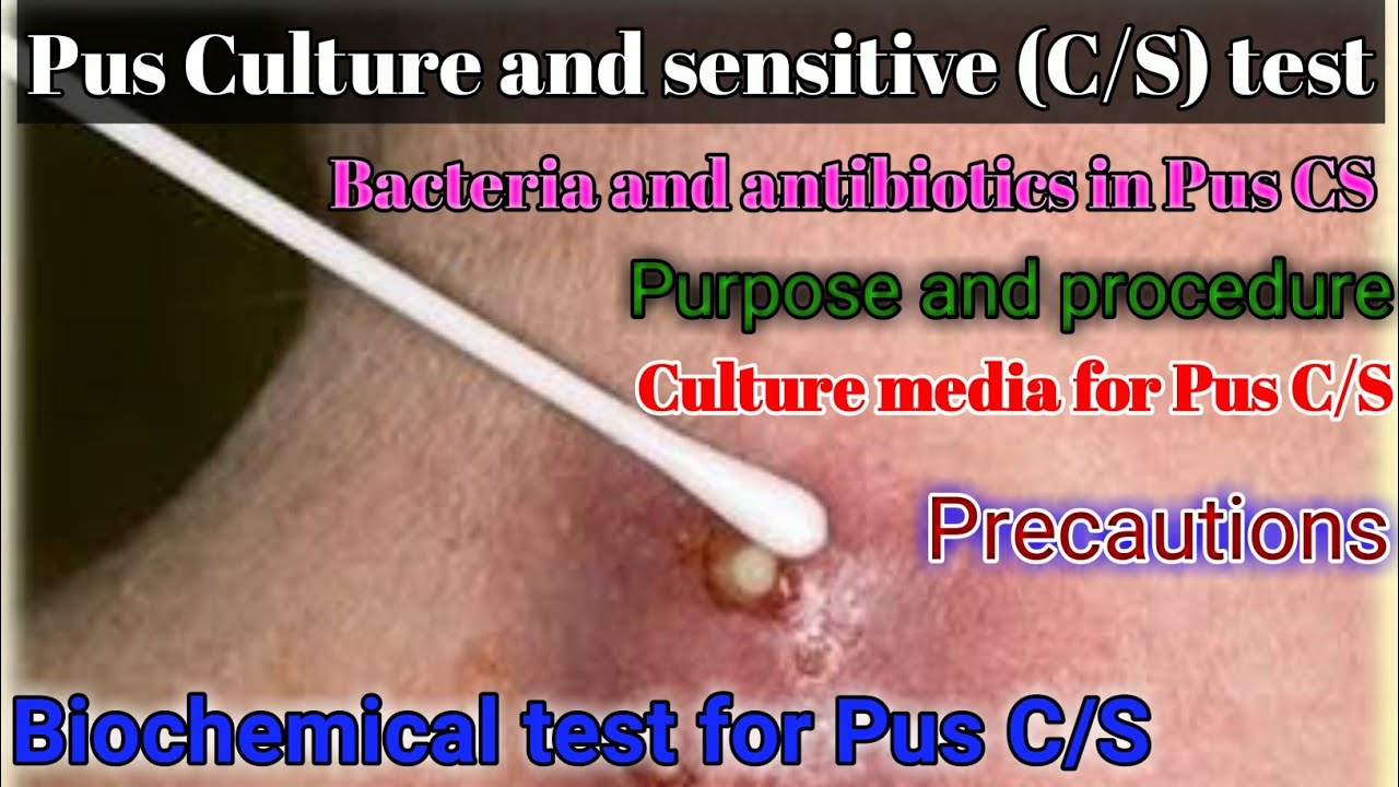 Pus Culture and Sensitivity (C/S) test: full explained - YouTube