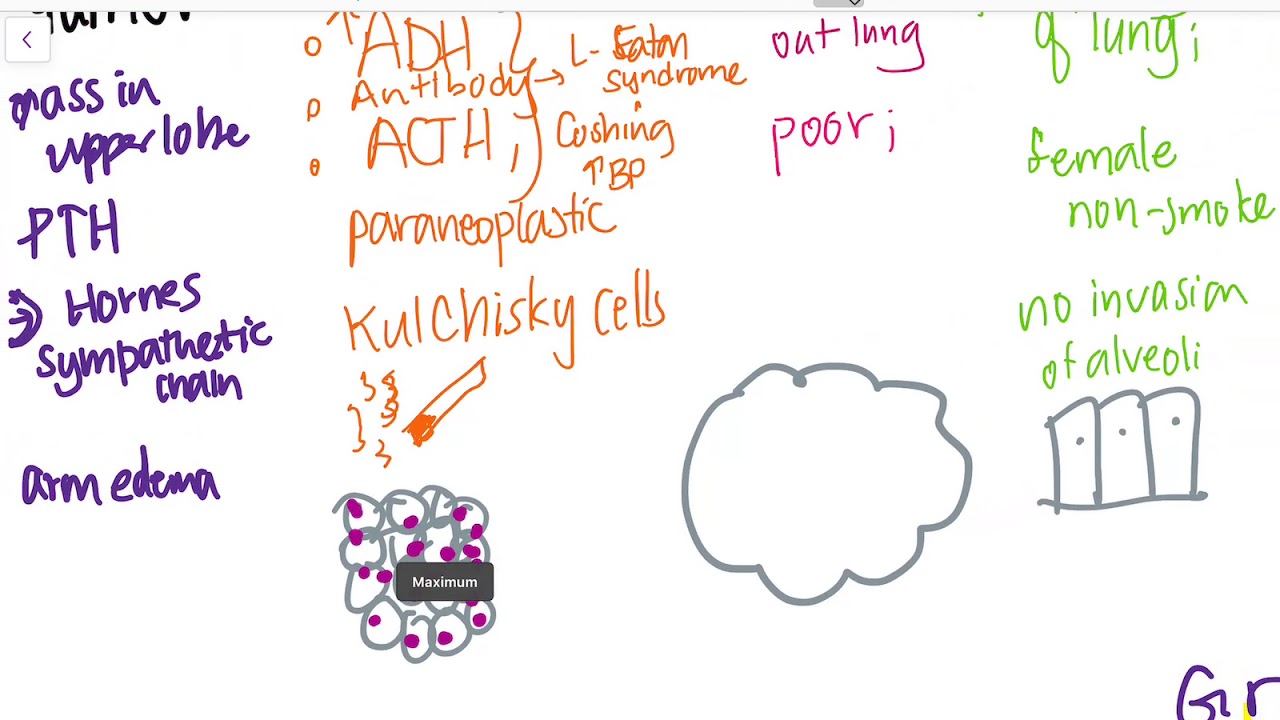 Respiratory Lung Cancer Overview - YouTube