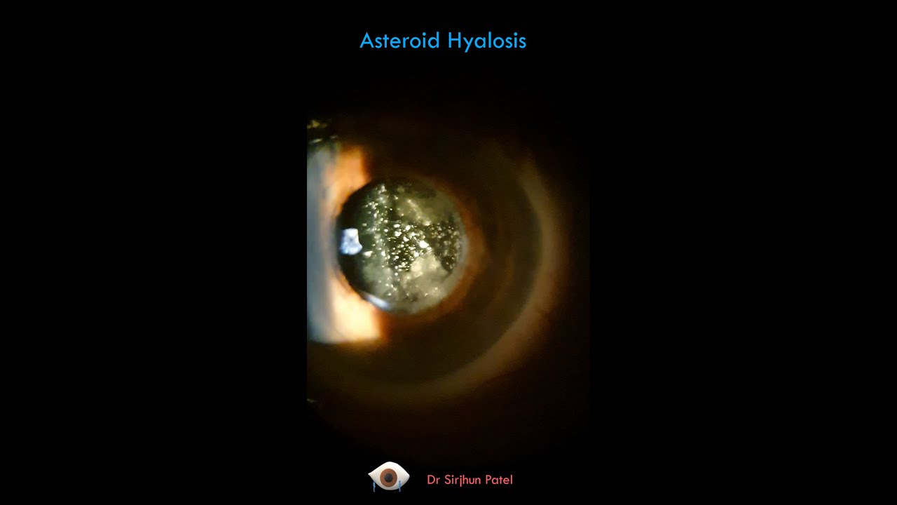 Asteroid Hyalosis Photos Og