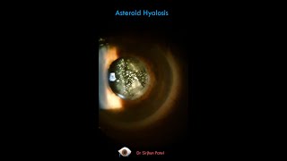Asteroid Hyalitis