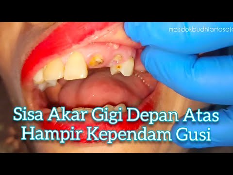 Dua Akar Gigi Depan Atas Hampir Kependam Gusi Suka Bikin Gusi Jerawatan ...