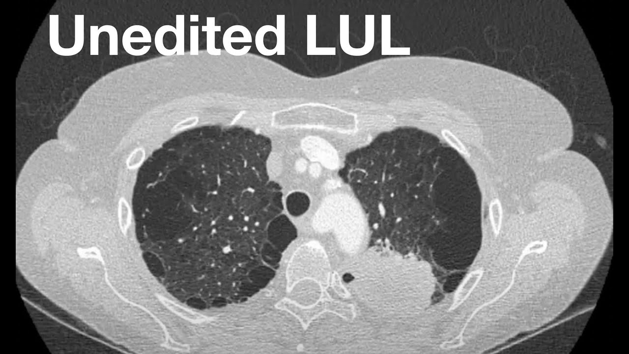 Robotic left upper lobectomy for a T3 N0 lung cancer - unedited - YouTube