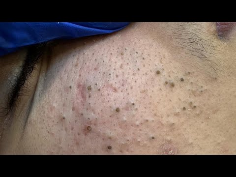 Deep Facial Cleansing | Acne Treatment, Blackheads Removal & Skincare Routine
