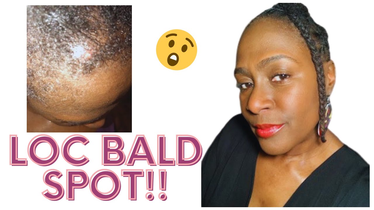 Loc Balding - How my Loc started balding, tight styling, loc styles ...