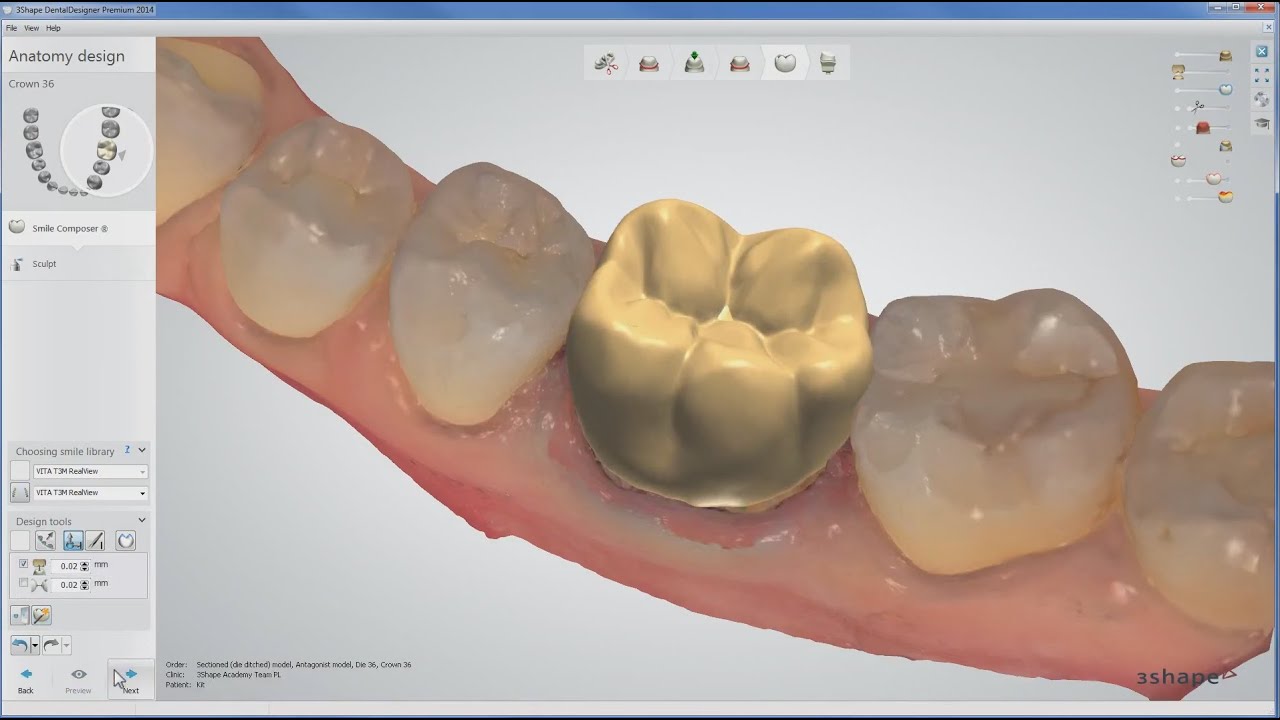 Full anatomical crown on TRIOS® scan - YouTube