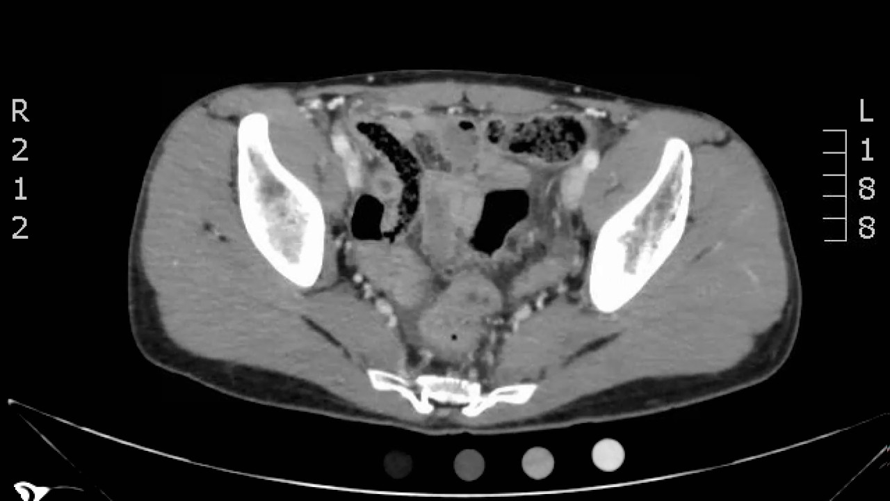 Appendicitis Annotated, CT. JETem 2017. - YouTube