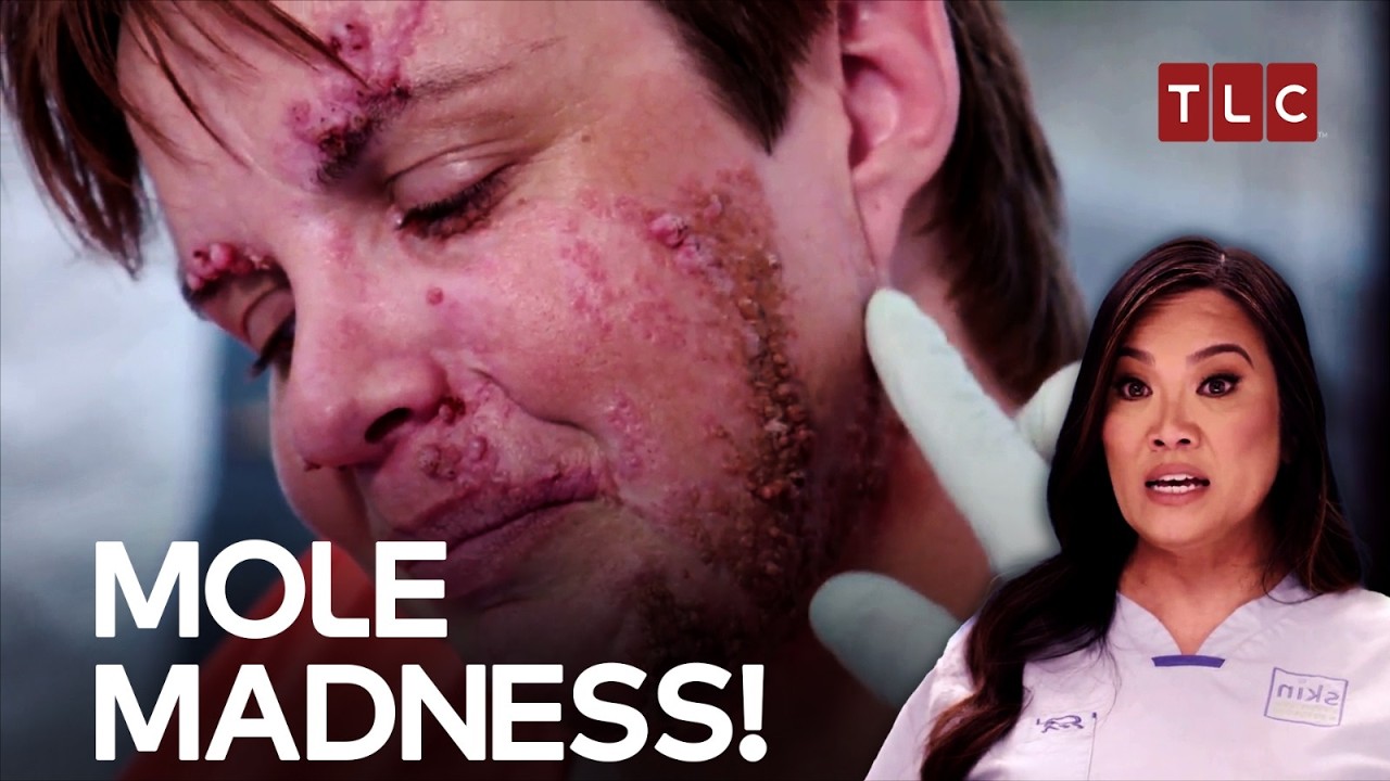 The Moles That Never Fade Away! | Dr Pimple Popper TLC - YouTube