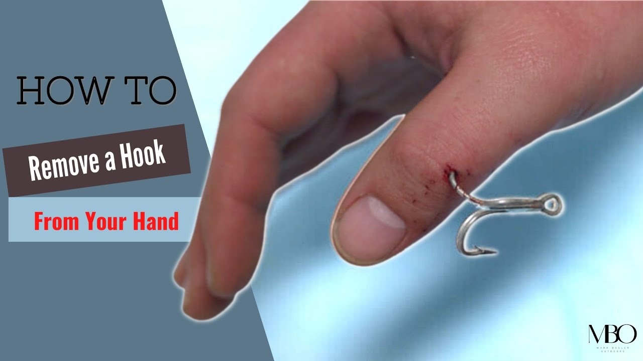 How To Remove a HOOK From Your HAND with Nothing but Fishing Line ...