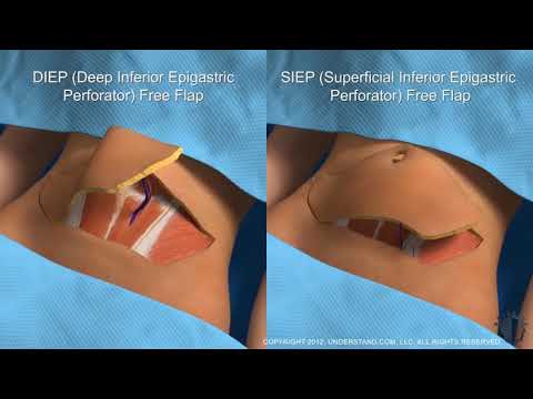 Breast Reconstruction Animation - YouTube