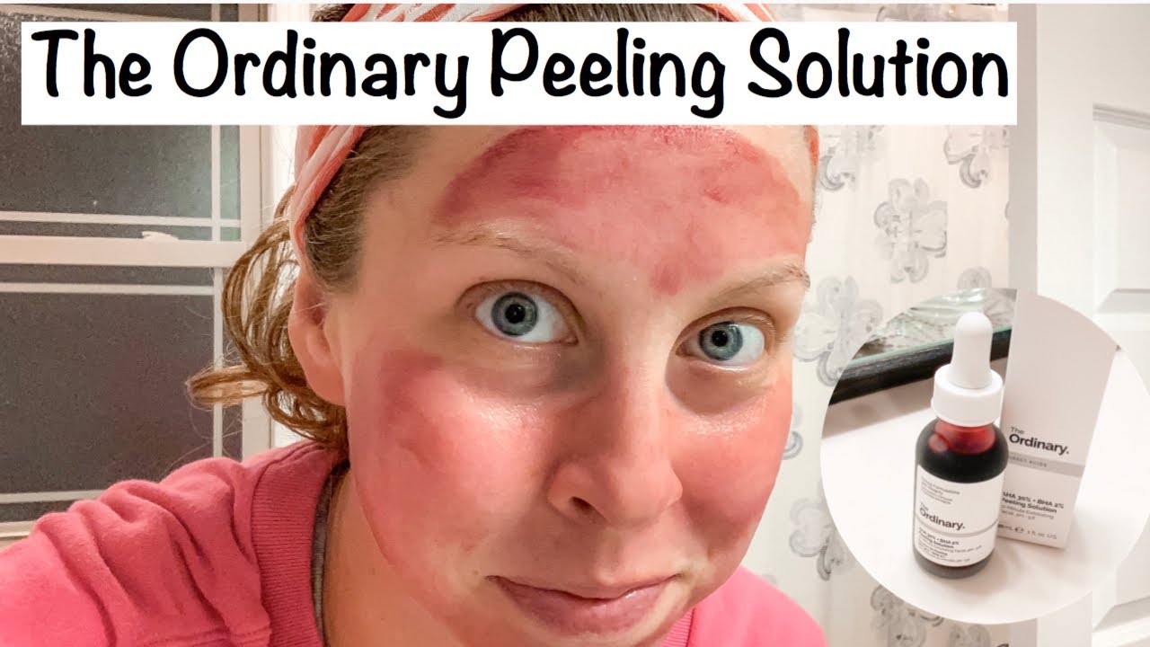 MY FIRST TIME TRYING THE ORDINARY FACE PEELING SOLUTION - YouTube