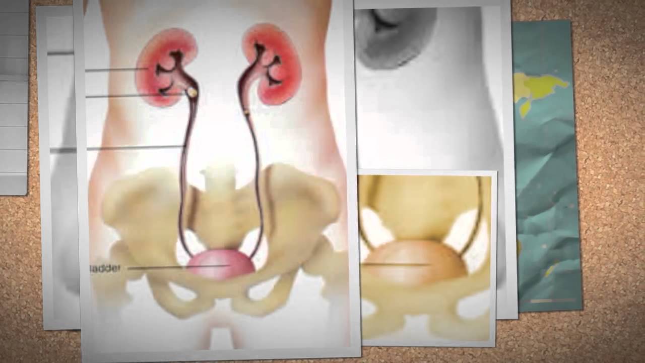 5 Mm Renal Calculus YouTube