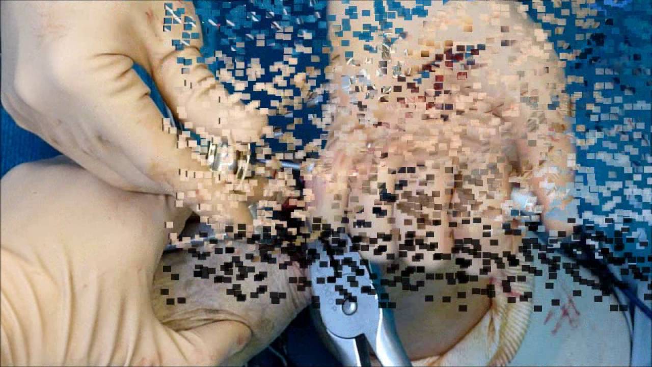 Argomedical - PROSTHELAST - YouTube