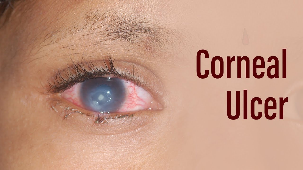 Corneal ulcers open sores on the cornea; Causes, symptoms, Diagnosis ...