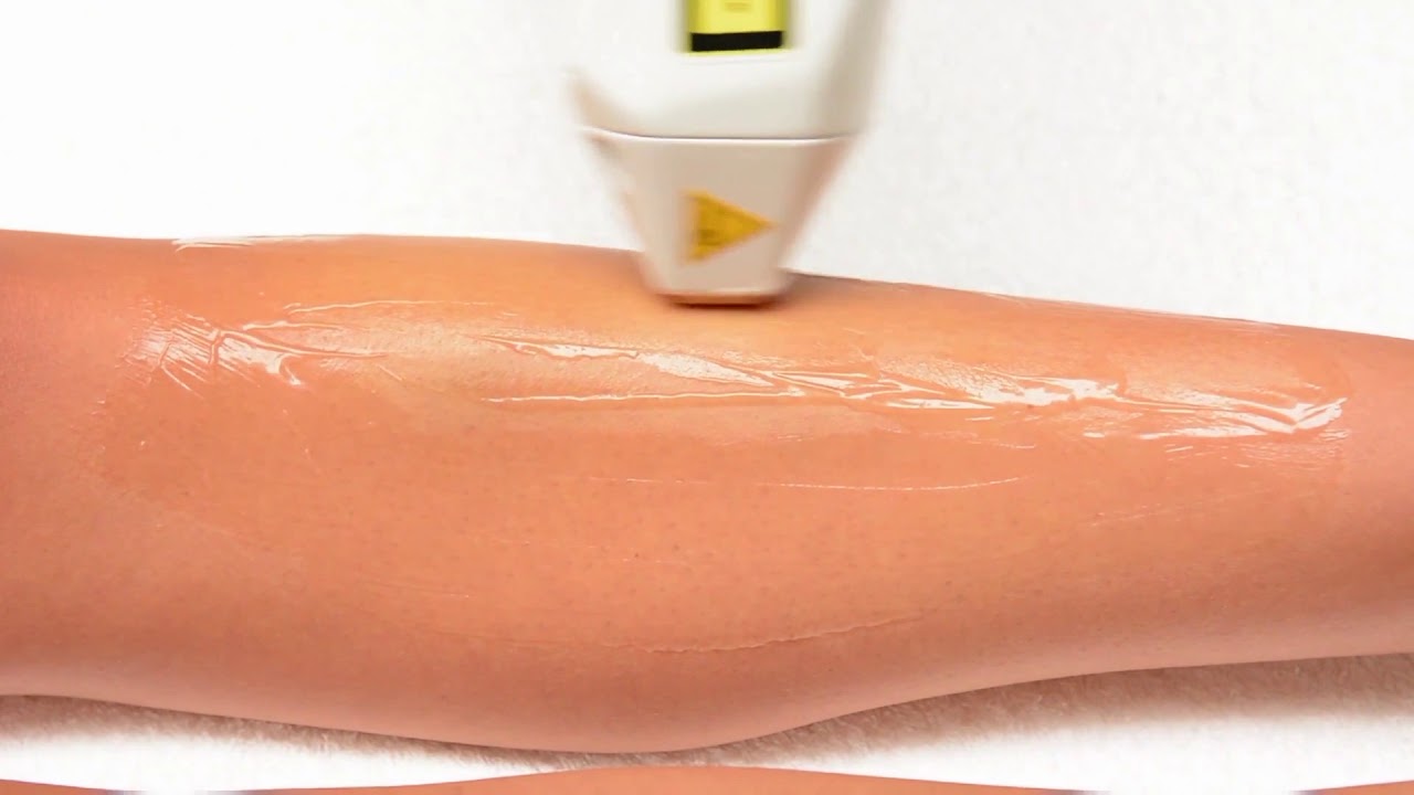 Xlase Plus La piattaforma laser modulare - YouTube