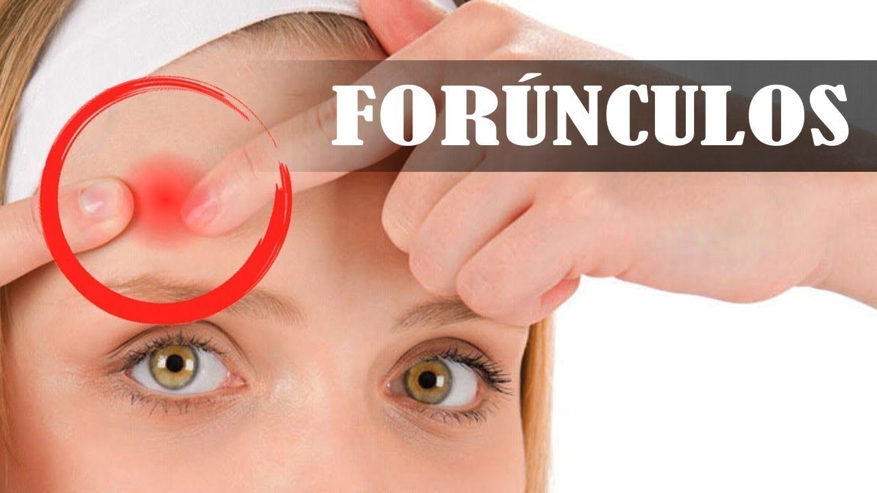Como Aliviar El Dolor De Un Forunculo 🎄 Como Se Cura Un Forunculo En El ...