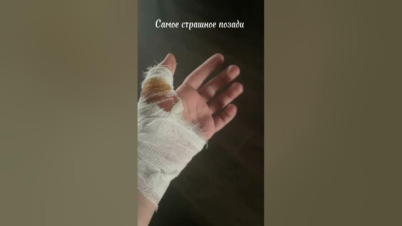 После перевязки - YouTube