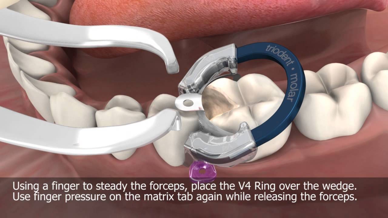 V4 ClearMetal Matrix System - YouTube