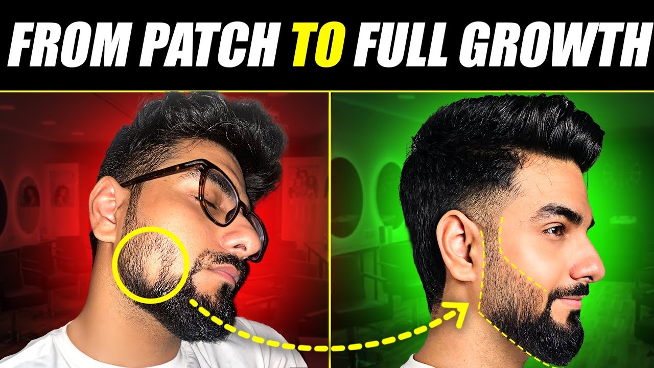 This is How I Treated a DANGEROUS Beard Patch? 😰 Alopecia Areata ...
