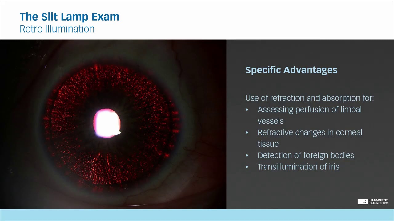 The Slit Lamp Exam - Episode 5 Retro Illumination - YouTube