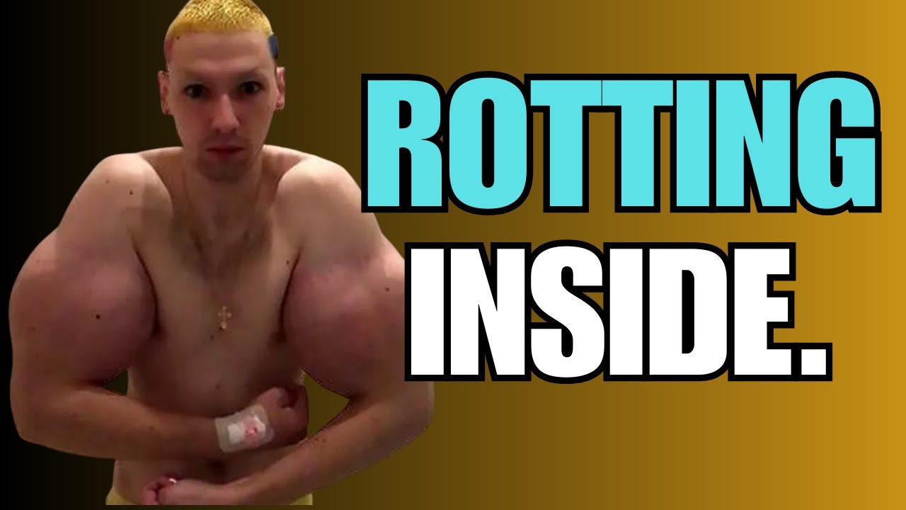 I Removed 3lbs of Rotting Muscle: The Russian Popeye - YouTube