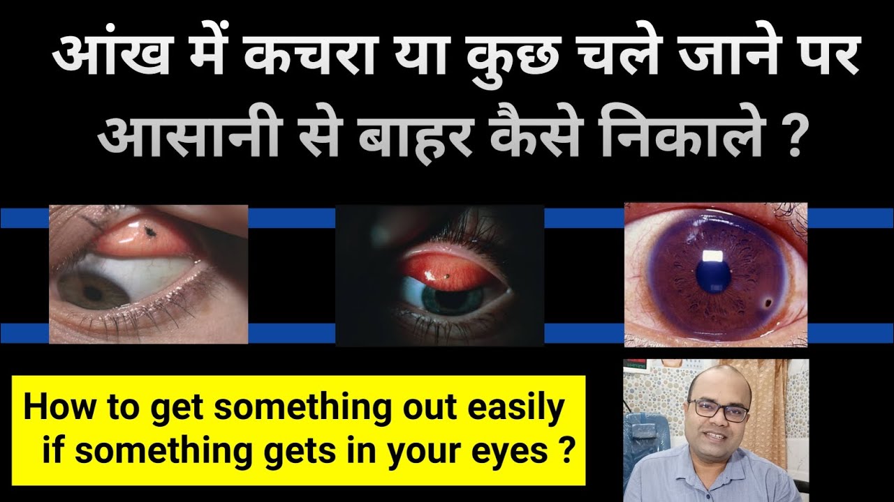 आंख में कंकड़, धूल, कचरा चला जाए तो आसानी से कैसे निकाले | Aankh me se ...