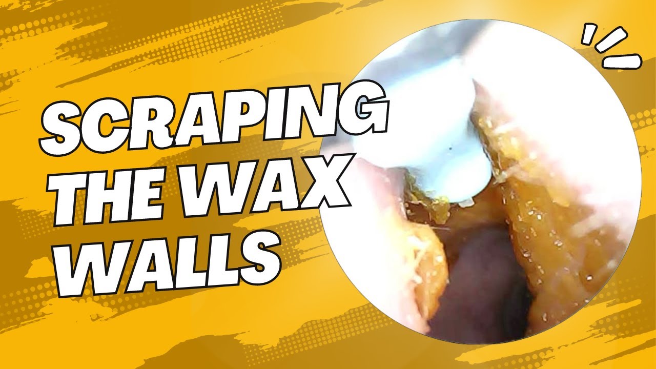 Ear Wax Extraction Episode 7: Scraping the Wax Walls - YouTube