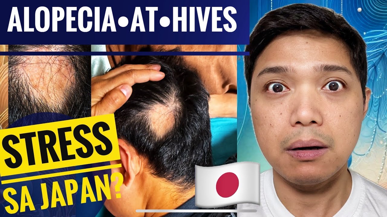 🇯🇵🇵🇭ALOPECIA AT HIVES URTICARIA EPEKTO NG STRESS KO SA JAPAN LIVING ...