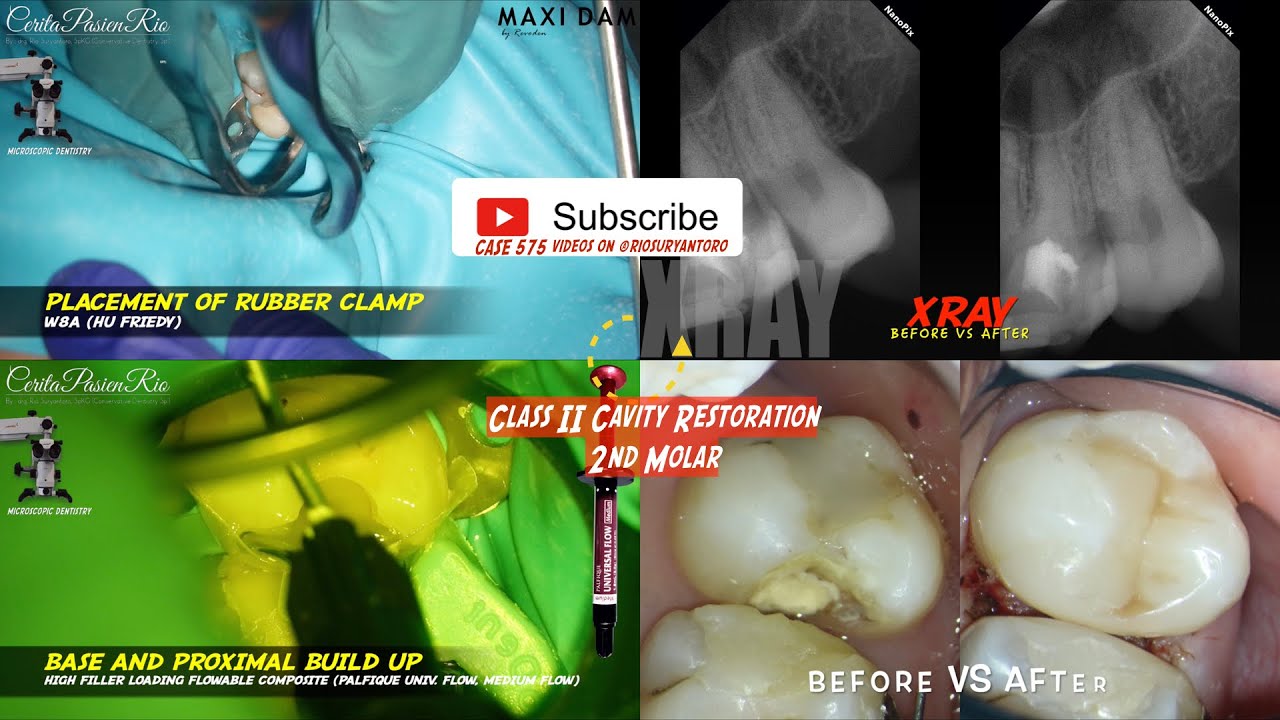 RUBBER DAM PLACEMENT MULTIPLE ISOLATION + CLASS 2 RESTORATION COMPOSITE ...