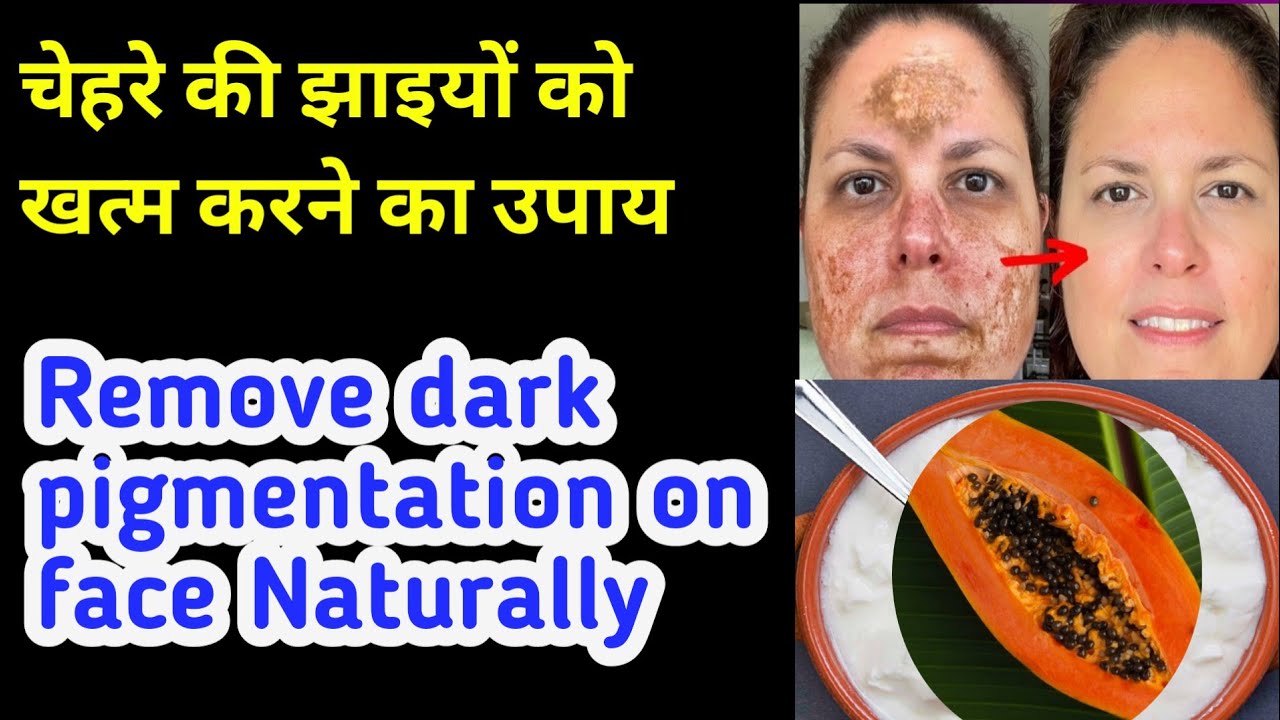 How to remove Dark Pigmentation on Face/ चेहरे की झाइयों का इलाज। - YouTube