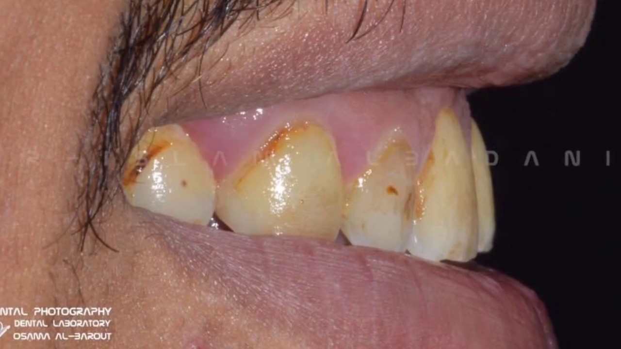 Composite injection technique full case - YouTube