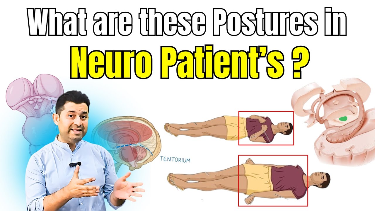 Understand Decorticate & Decerebrate Postures in 2 Minutes. - YouTube