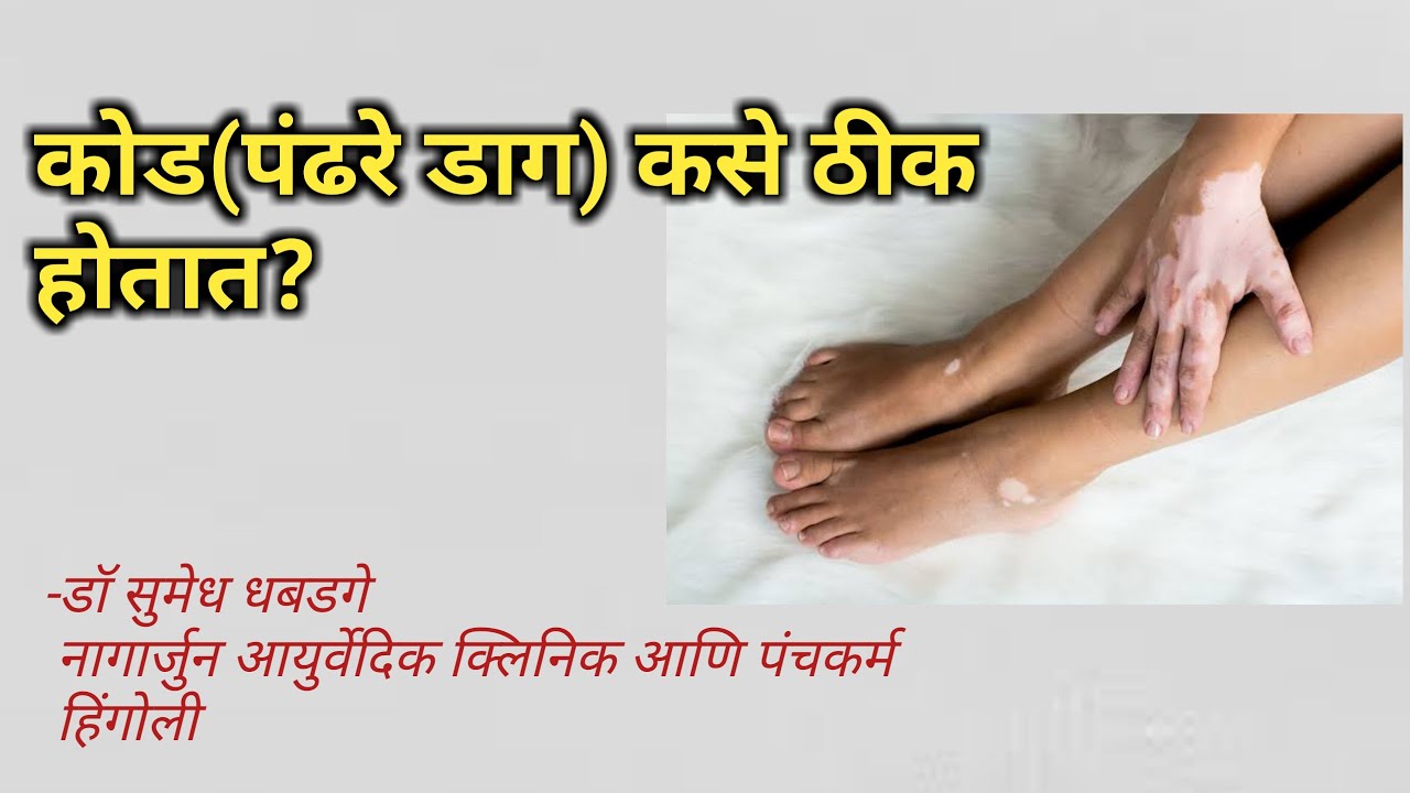 pandhare dag upchar in marathi,पांढरे डाग कोड उपाय, kod ka hoto, कोड का ...