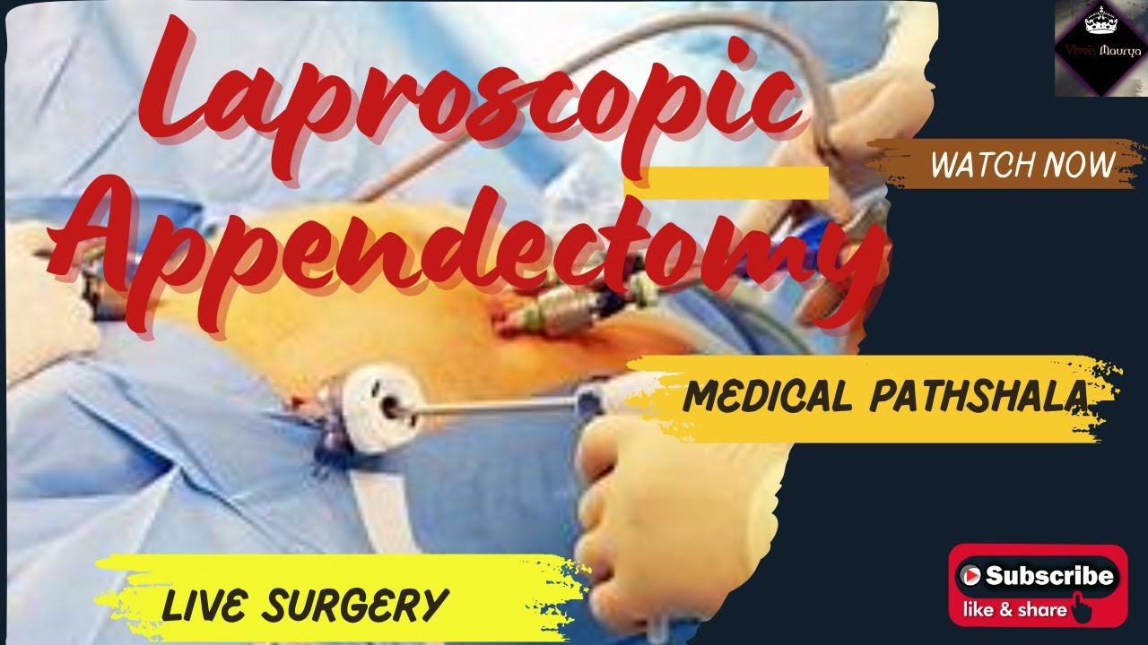 Laproscopic appendectomy ||Medical Pathshala #medicalstudents#ott#ottechnicians#medicalstudies ...