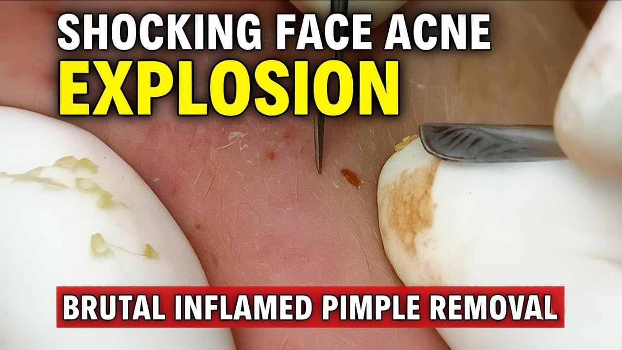 Shocking Face Acne EXPLOSION — Brutal Inflamed Pimple Removal - YouTube