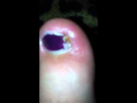 Infected ingrown toenail - YouTube