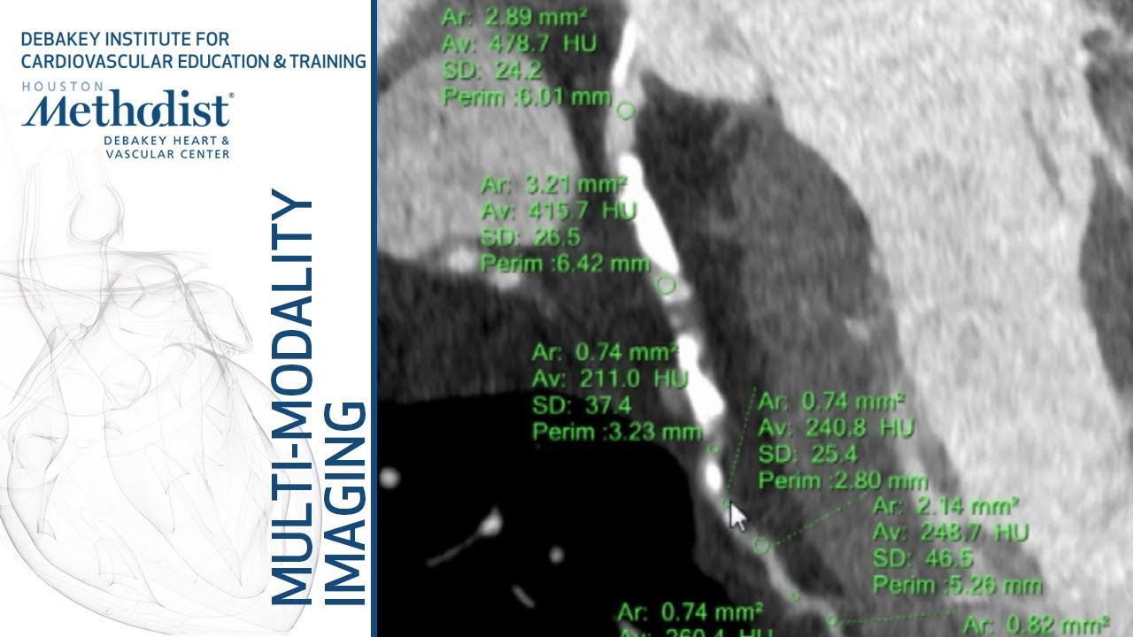 Coronary Imaging with CTA: Methodology, Advantages and Pitfalls (Su Min ...