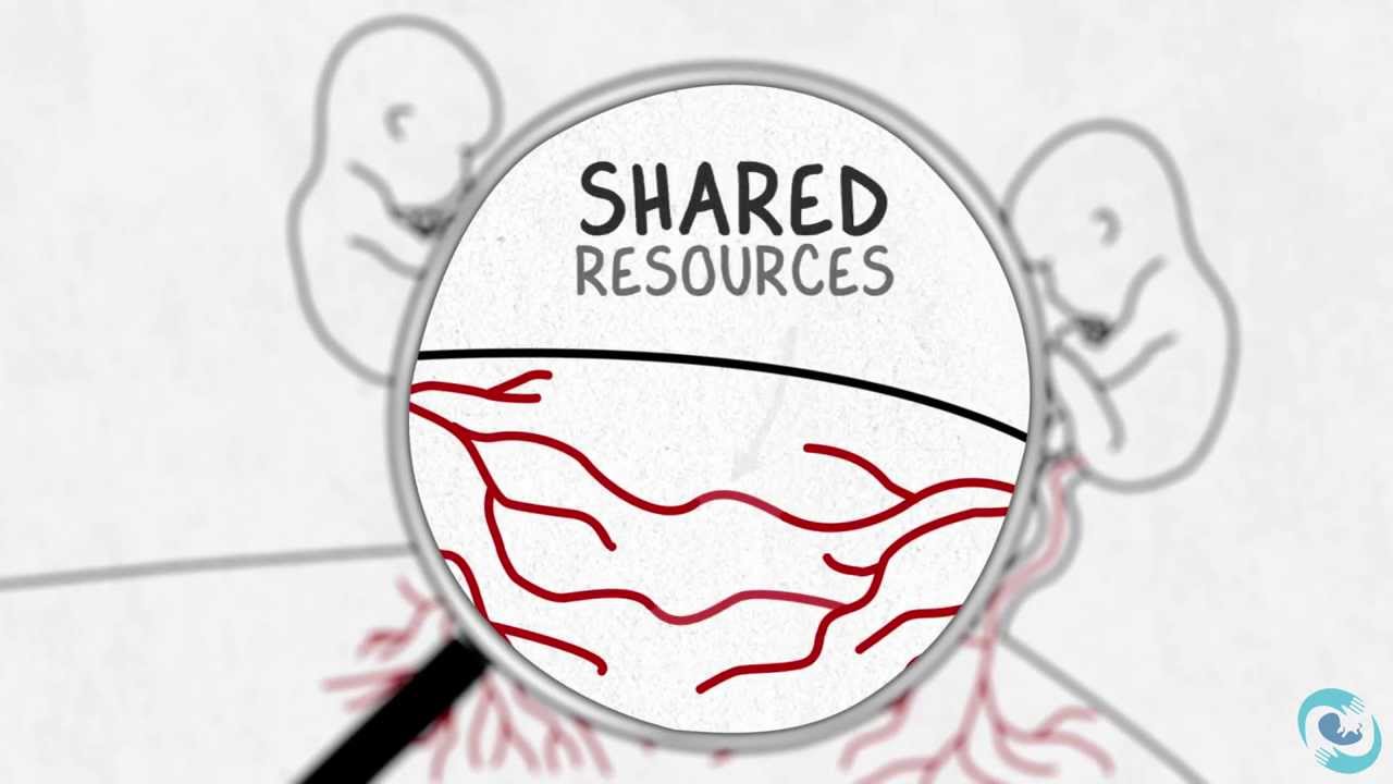 Monochorionic vs Dichorionic Twin Pregnancy - YouTube