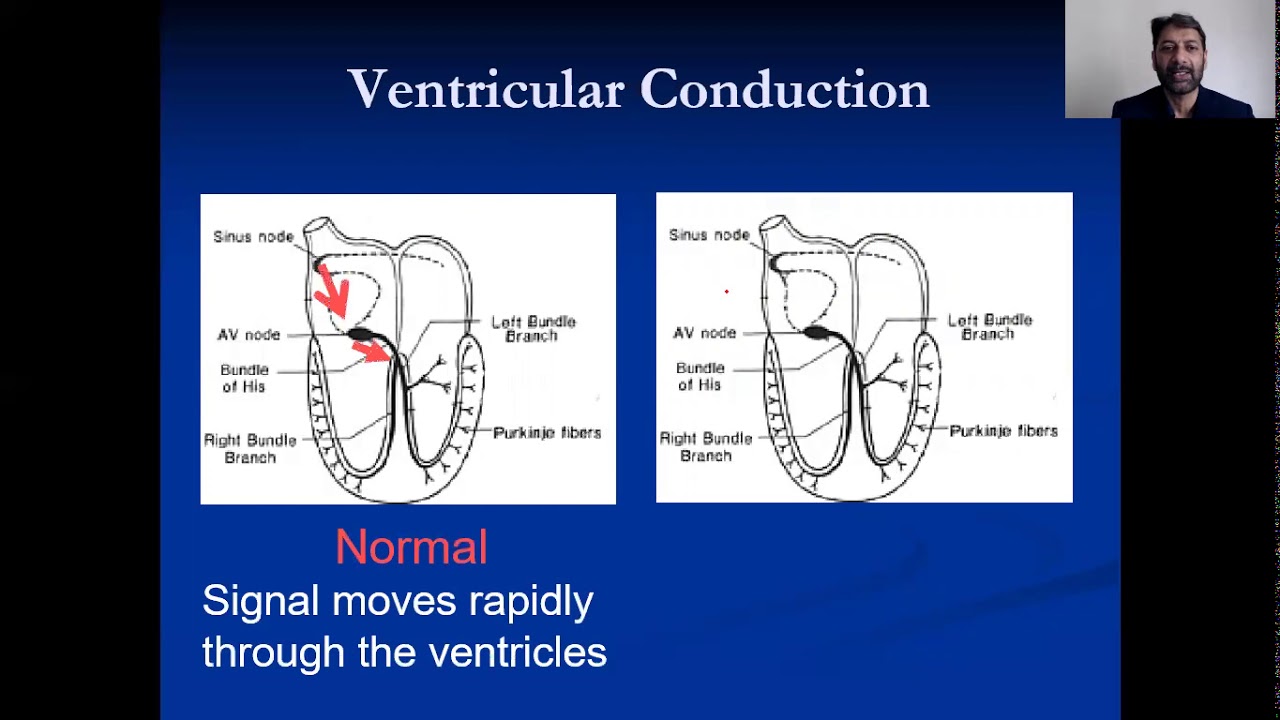 PVC Premature Ventricular beat Interpolated English Dr.Fawad Farooq ...