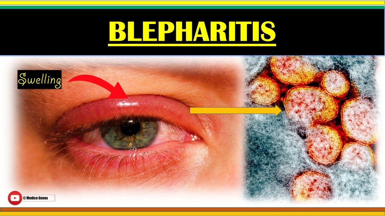 Blepharitis | Causes | Sign & Symptoms | Pathophysiology | Treatment ...