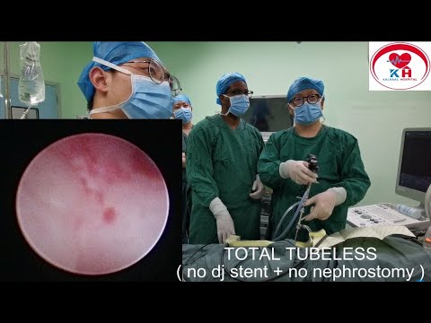 Mini PCNL ( SMP ) for upper ureteral stone, fluoroless usg guided laser ...