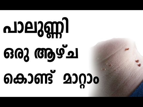 Skin Tag Home Remedy 100% working In One Week - YouTube