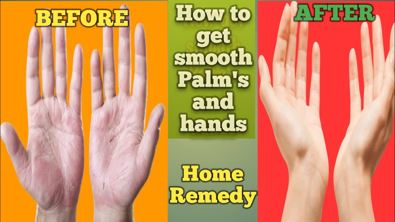 Homemade tips for smooth Palm's/how to get smooth and gentle palms ...