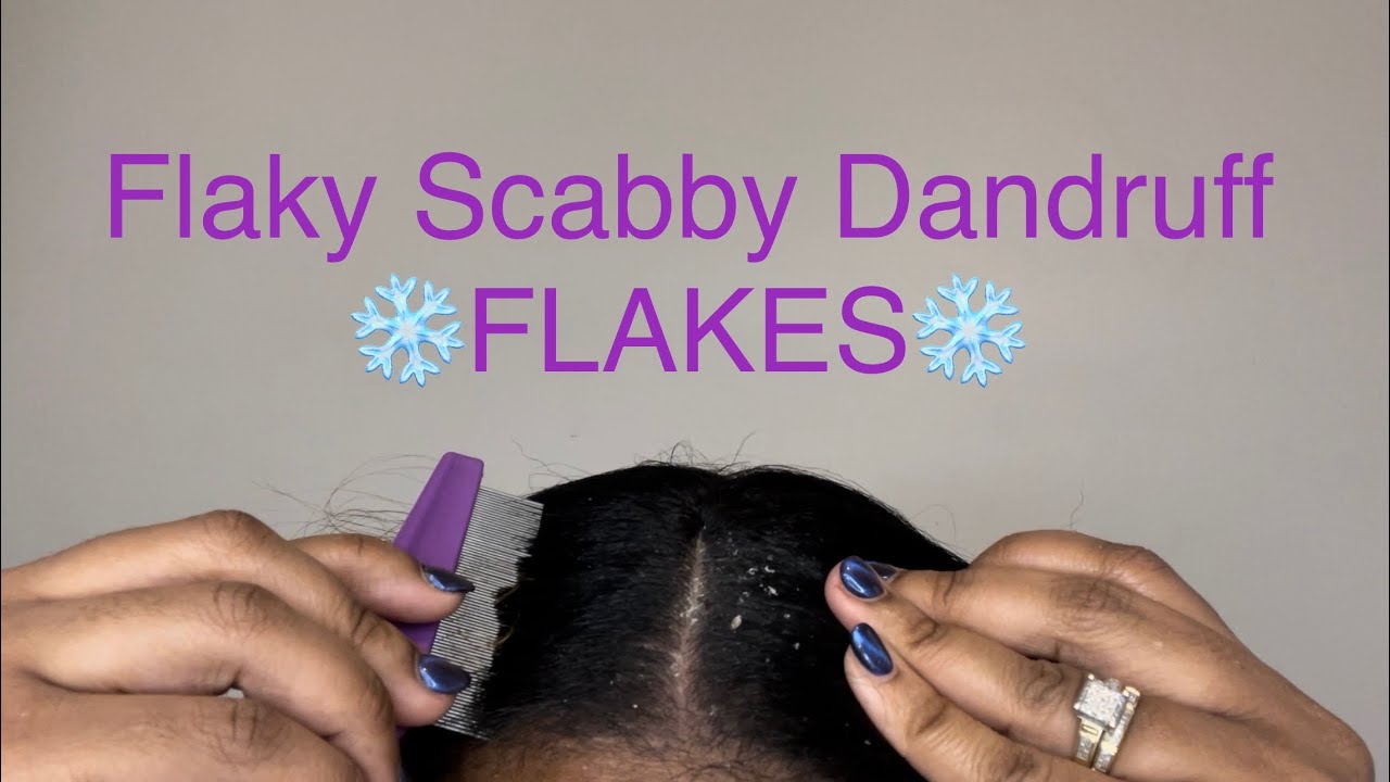 Dandruff Scratching | Raking Patches of Scabs on Scalp | Picking Scabby ...